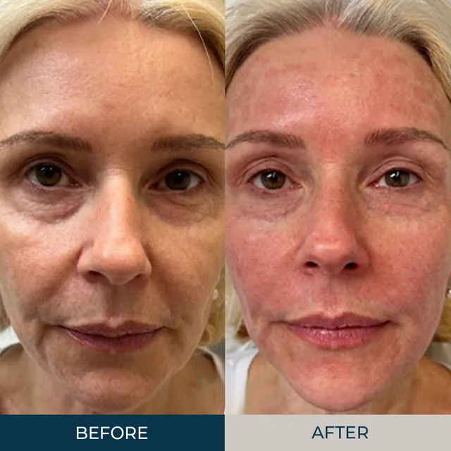 How RF Microneedling Boosts Collagen - Verve Medical Aesthetics ...